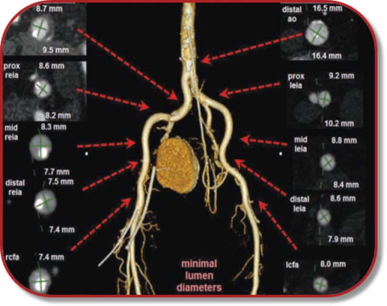 TAVR-TAVI CT Comprehensive – CTCourse